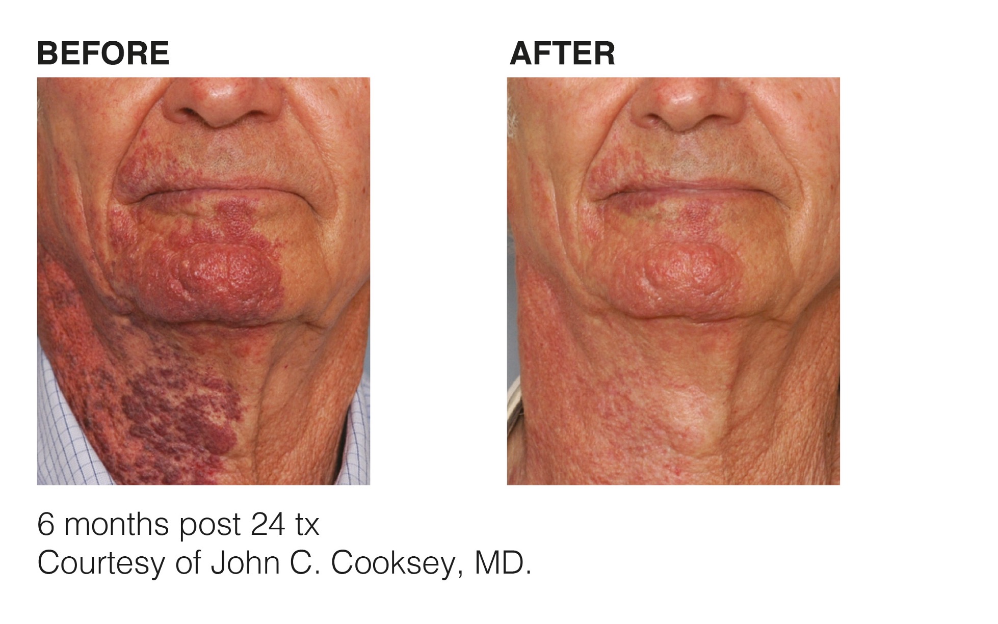 Address Vascular Skin Concerns in Cedar Rapids, IA – Cosmetic Solutions